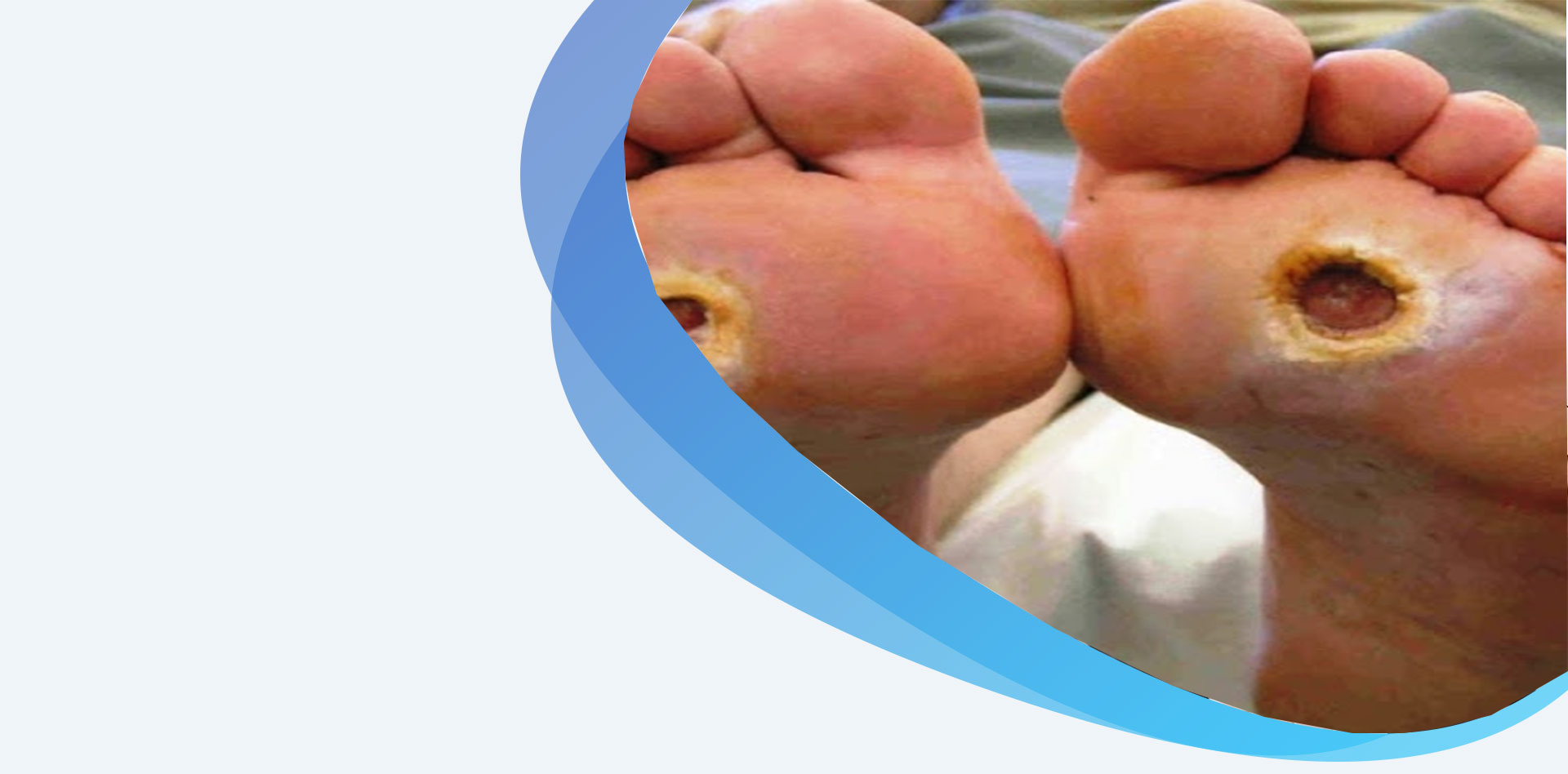 Diabetic Foot Infections
